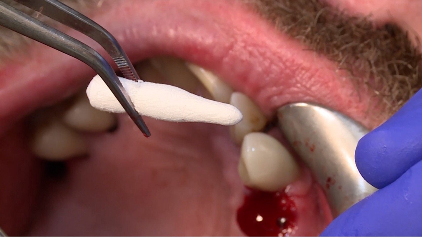 OsteoGen® Plug: Clinical Guide